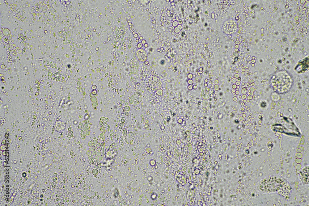 Foto Coughing up mucus and phlegm from a chest infection from a virus ...