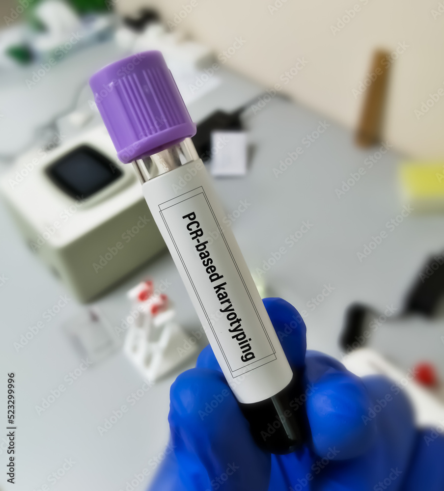 Blood sample for PCR based karyotyping testing. Genetic disorder ...