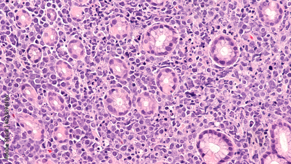 Photomicrograph showing pathology of Burkitt lymphoma, a rare but ...