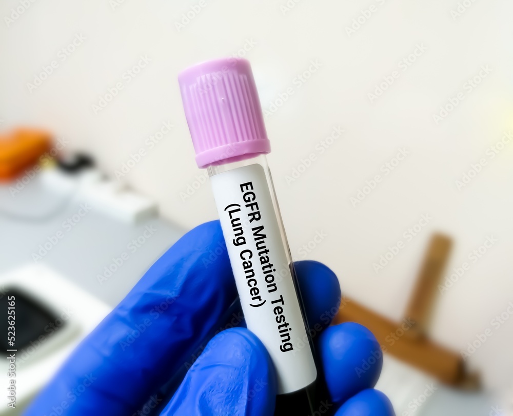 Molecular biologist holding blood sample for EGFR mutation test for the ...