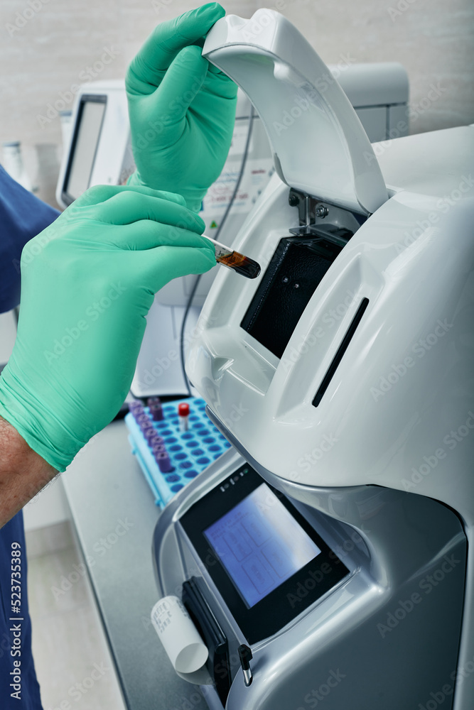 Erythrocyte sedimentation rate test. Laboratory technician loading ...