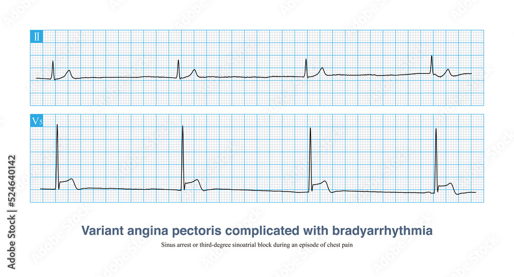 Illustration Stock A 76-year-old man presented with syncope during an ...