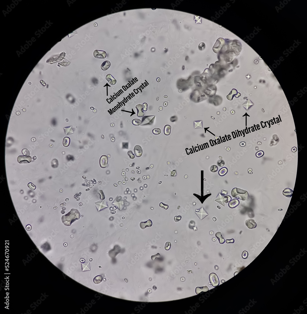 Microscopic image showing Calcium oxalate (monohydrate and dihydrate ...