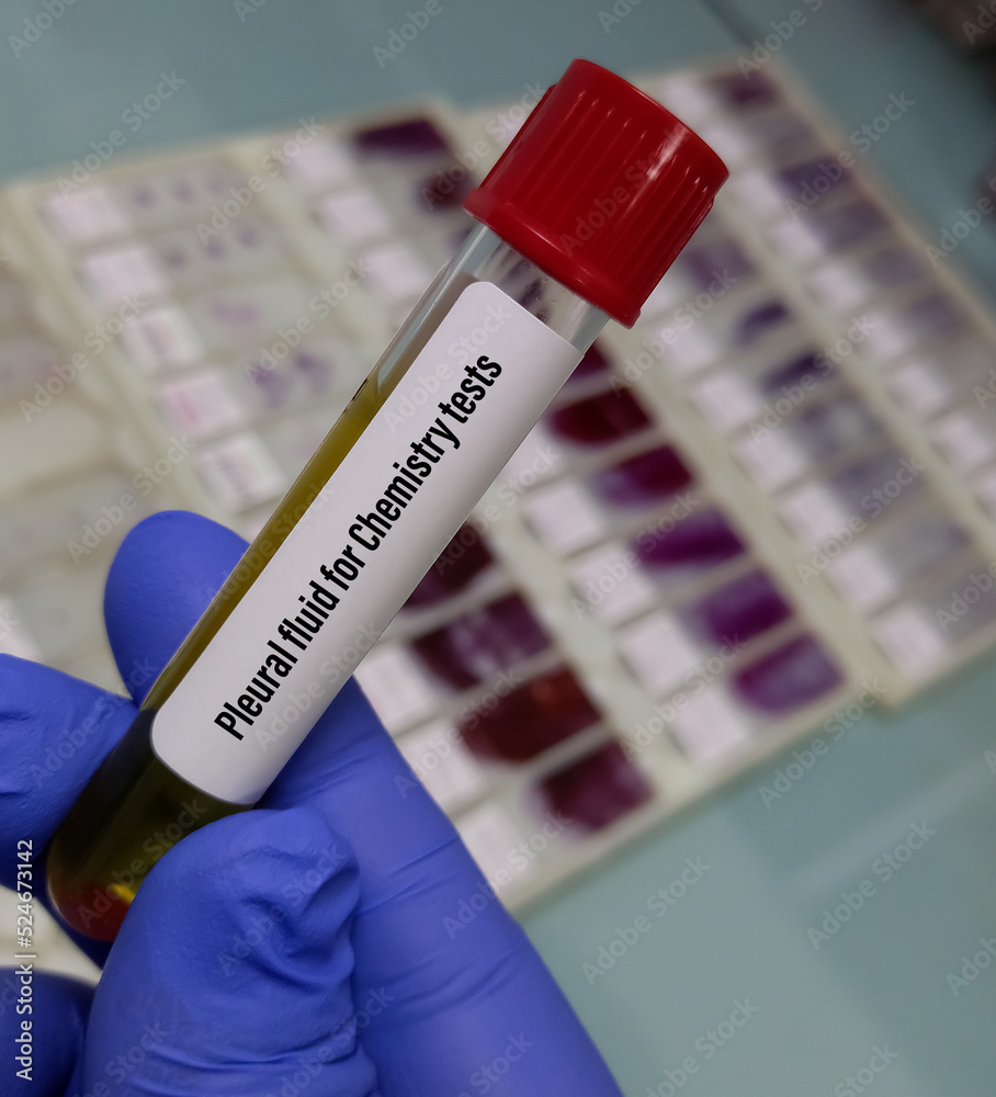 Pleural fluid sample for Chemistry tests (Glucose, Protein,LDH,ADA ...