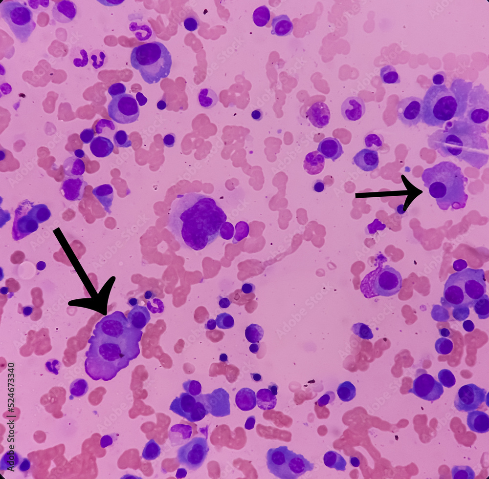Microscopic image of bone marrow. Plasma cell dyscrasia or Multiple ...