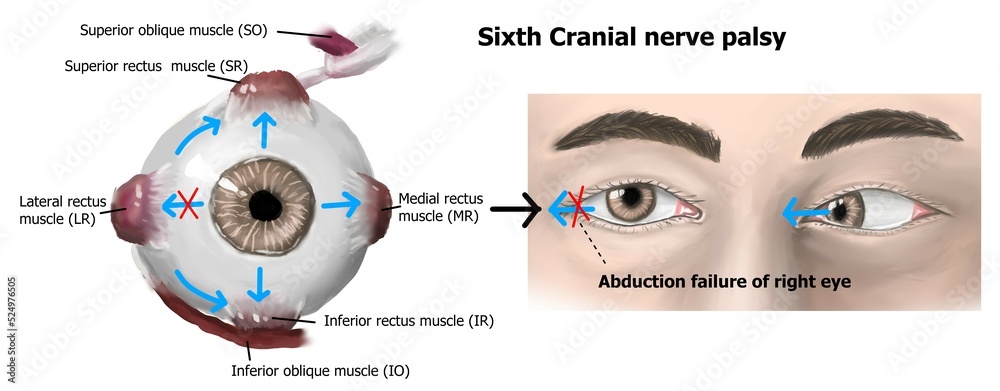 the clinical presentation of right sixth cranial nerve palsy. Stock ...