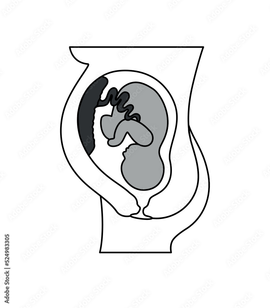 Placental previa. Fetus in Uterus During Pregnancy. Pregnancy women ...
