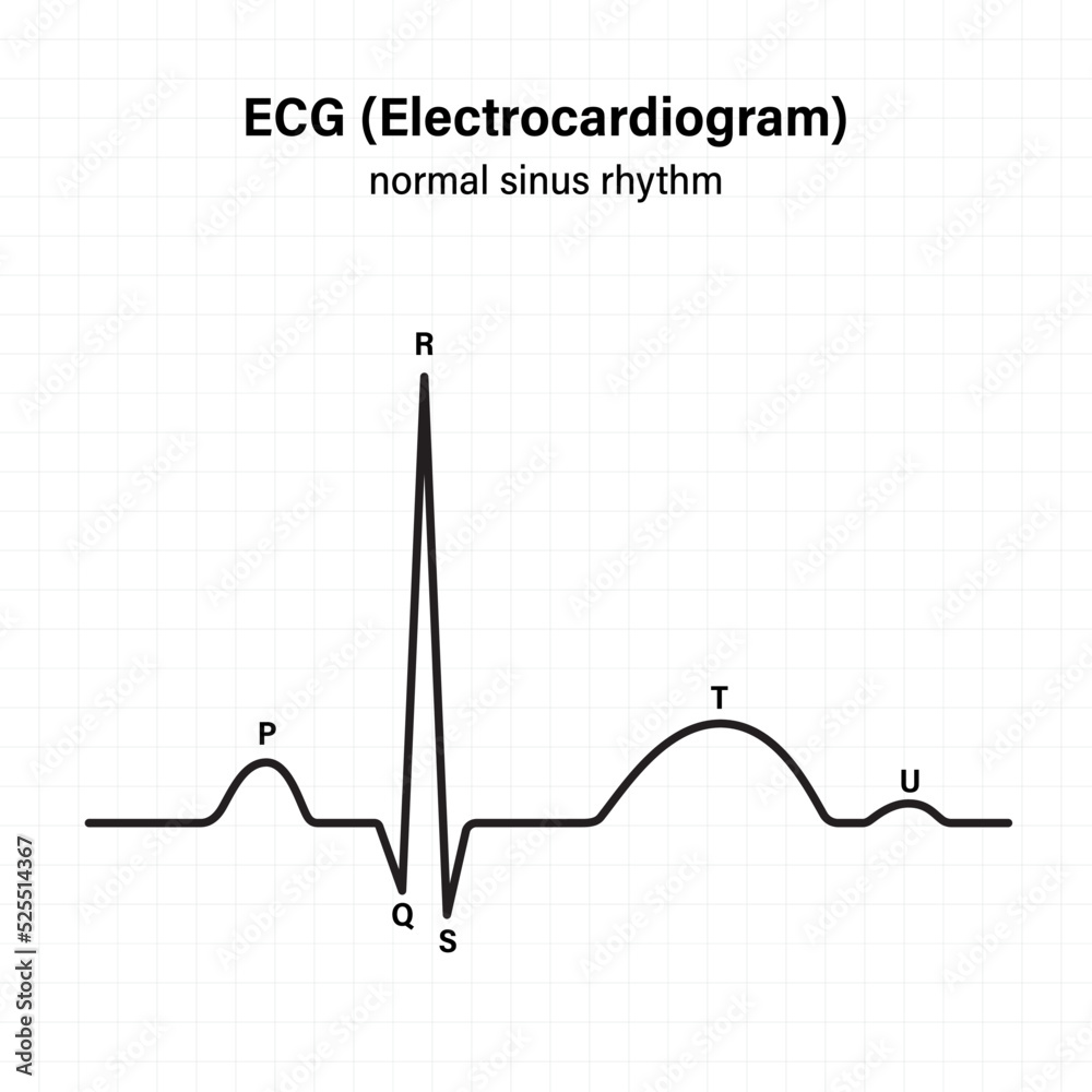 Diagram showing normal heart beat wave. Electrocardiogram of normal ...