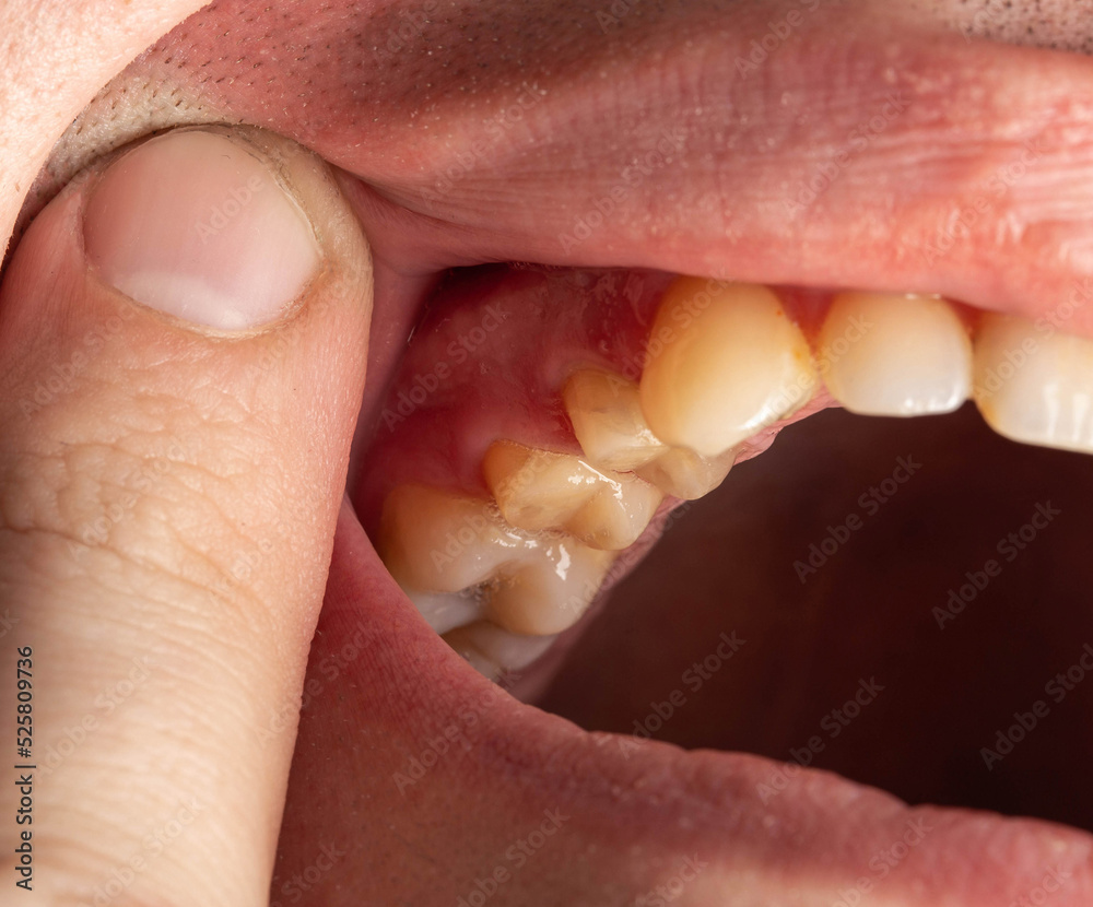 Ground prepared teeth before installing a porcelain fused-to-metal ...