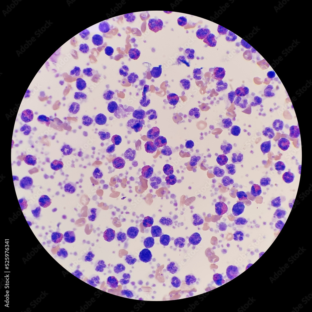 Buffy coat smear shows marked eosinophilia. Eosinophils are a type of ...