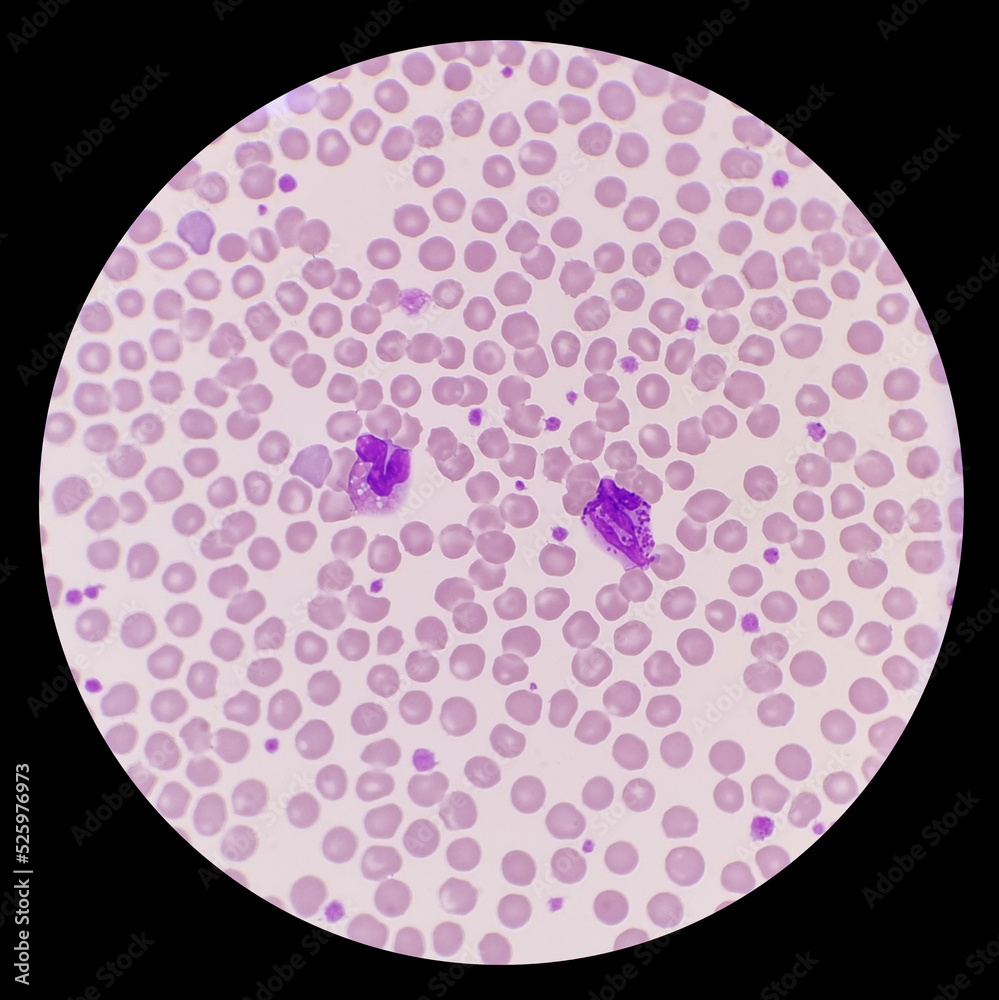 The peripheral blood smear shows eosinophil, basophil, erythrocytes and ...