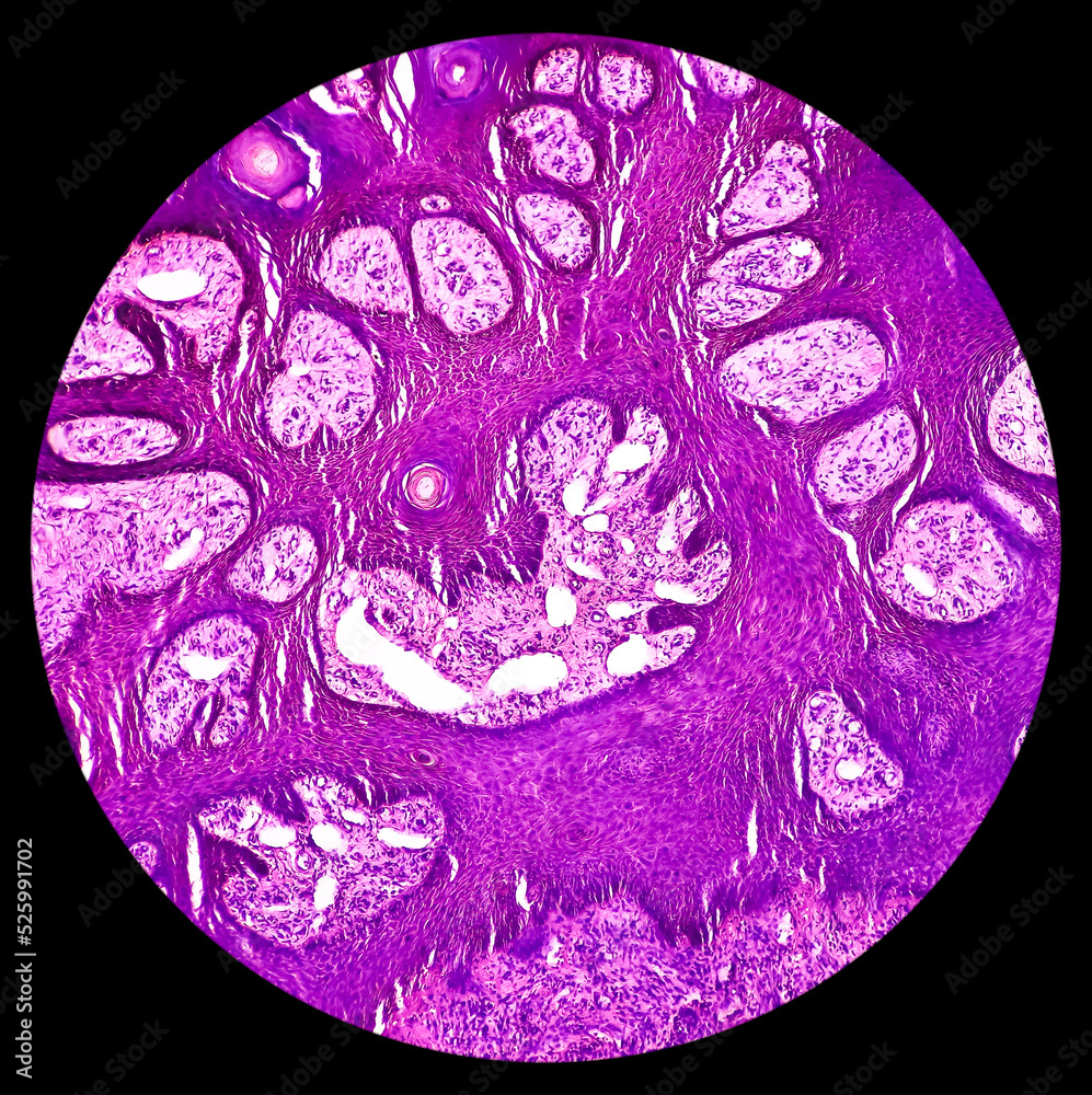 Non healing ulcer on scalp, microscopic image show skin, features of ...