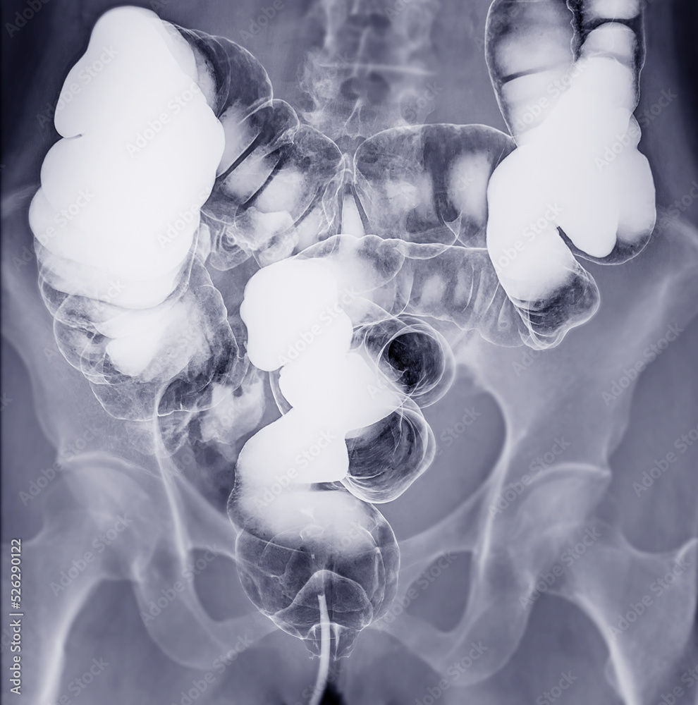 Barium enema or BE is image of large bowel after injection of barium ...