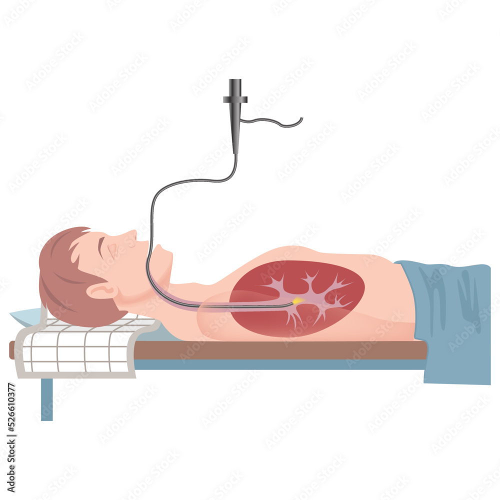 Bronchoscopy. The patient is in the supine position. Medical ...