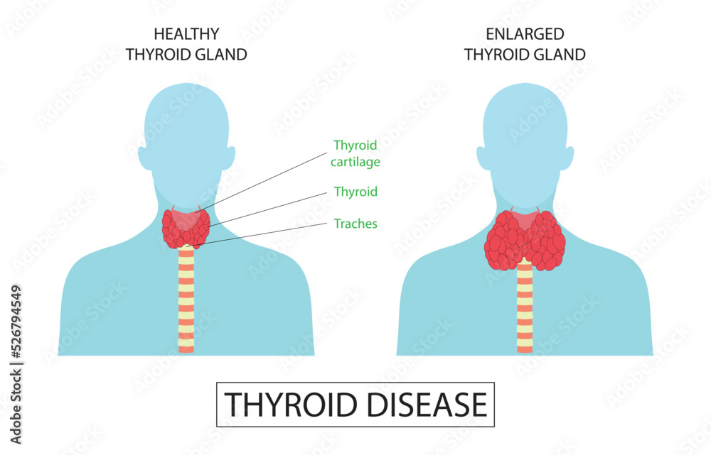 illustration of biology and medical, Thyroid disorders can range from a ...