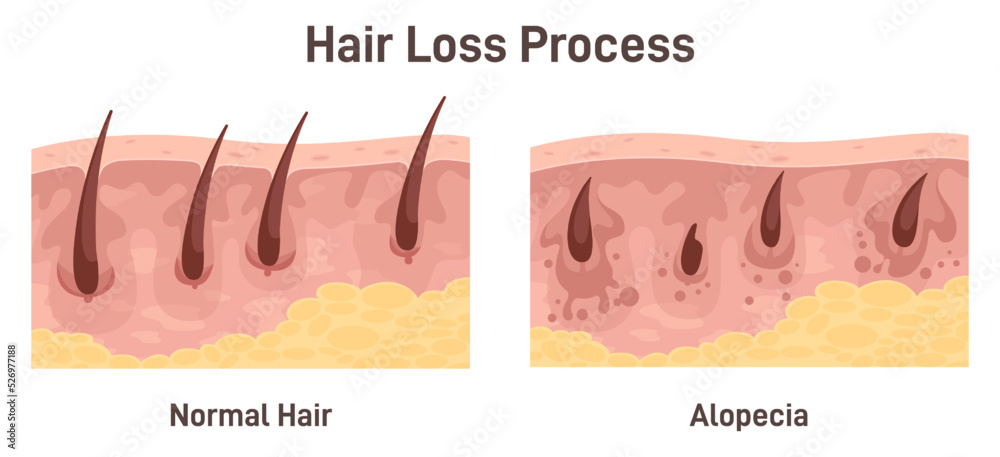 Alopecia. Hair loss, balding process. Cross-section anatomical ...
