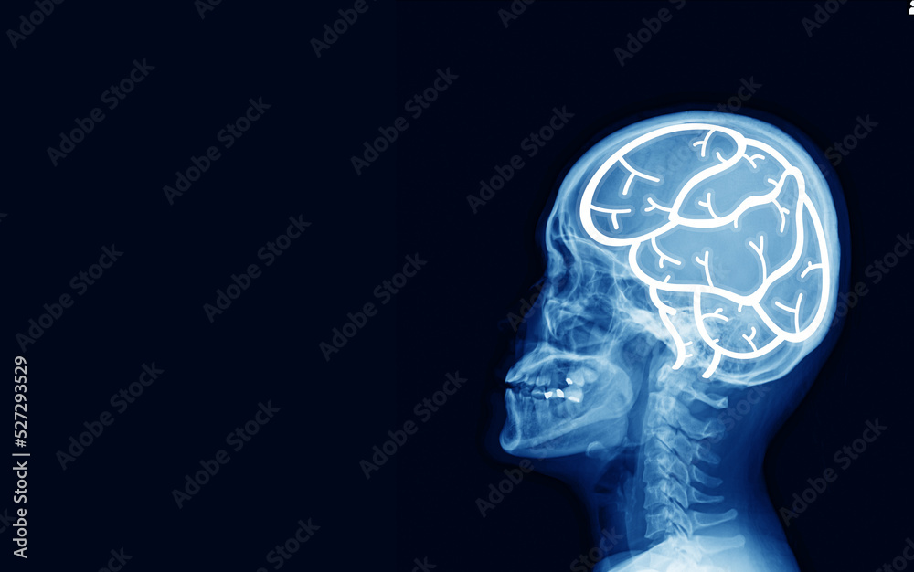 x-ray of human cervical spine and head skull .The sella turcica looks ...