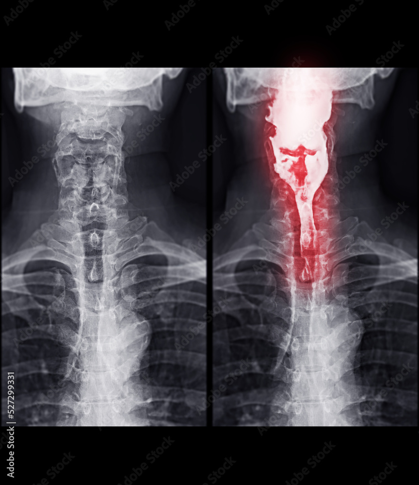 Barium Swallow study test diagnose Barrett's GI tract exam GERD ulcers ...