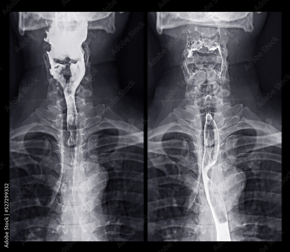 Barium Swallow study test diagnose Barrett's GI tract exam GERD ulcers ...