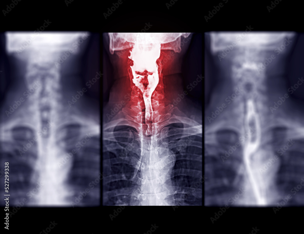 Barium Swallow study test diagnose Barrett's GI tract exam GERD ulcers ...