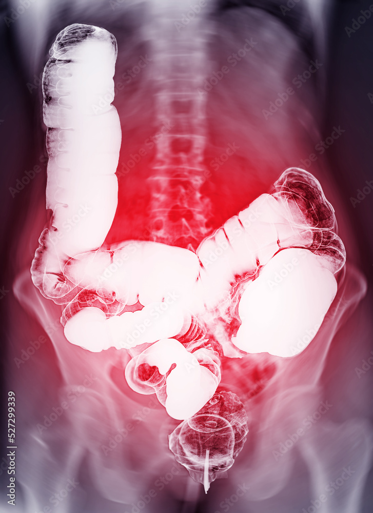 Barium enema or BE is image of large bowel after injection of barium ...