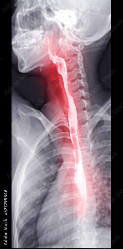 Barium Swallow study test diagnose Barrett's GI tract exam GERD ulcers ...