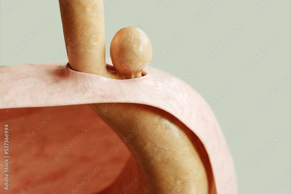 Paraesophageal Hiatus Hernia Type 2 - Stomach protrusion through ...