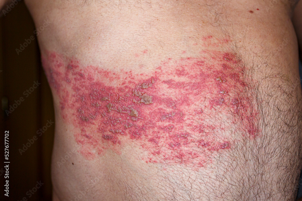 Foto de Stock Skin lesion symptom in Shingles or Herpes zoster in human ...