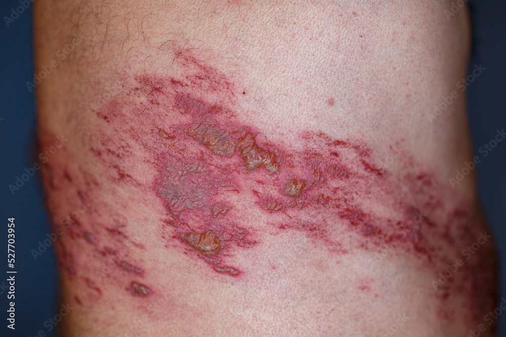 Skin lesion symptom in Shingles or Herpes zoster in human. Shingles or Herpes zoster is aviral ...