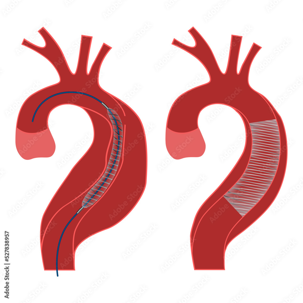 aortic aneurysm. Aortic stenting. Diagram with stages. Medical poster ...
