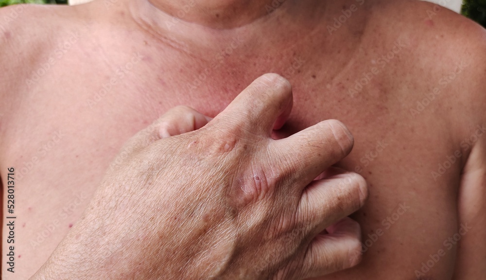 Foto de Stock Portrait showing dryness skin infections, allergic ...