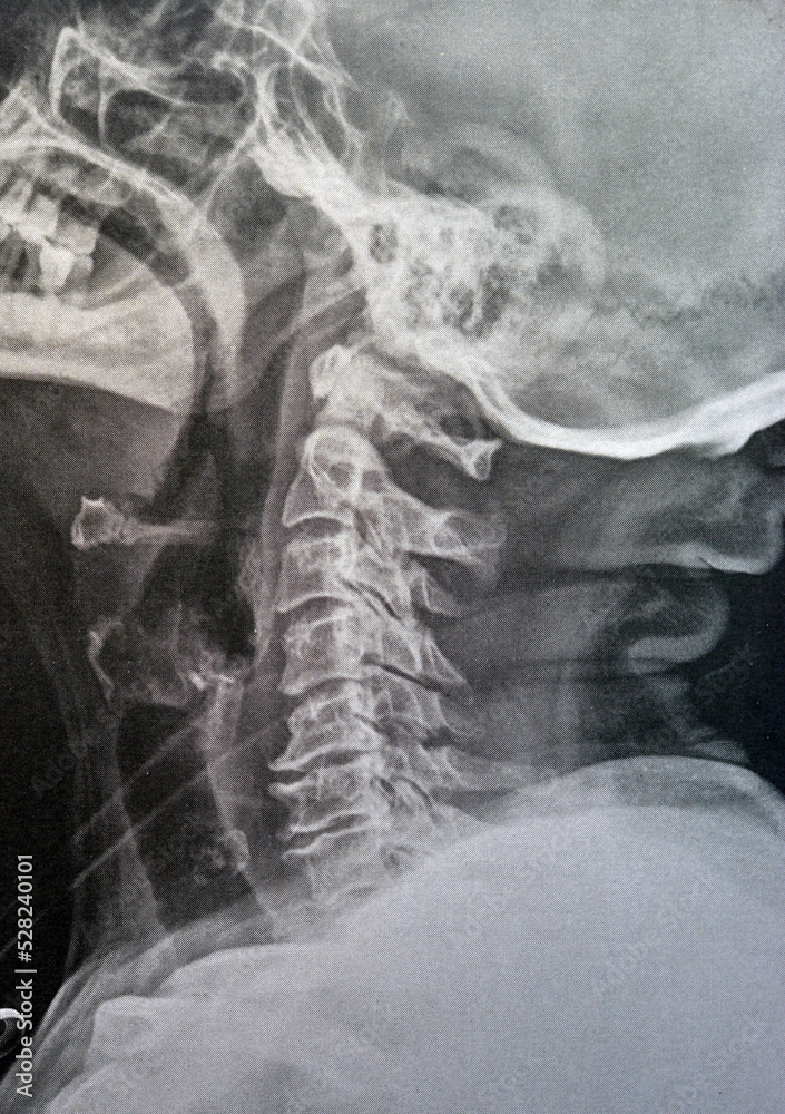 Plain X ray cervical vertebrae showing straightening of cervical ...
