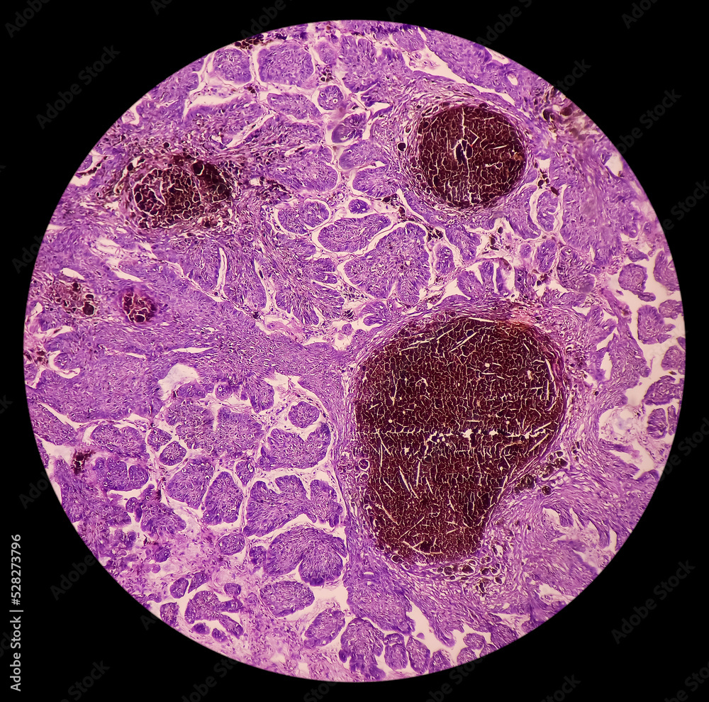 Skin biopsy, Scalp carcinoma, pigmented basal cell carcinoma, the most ...