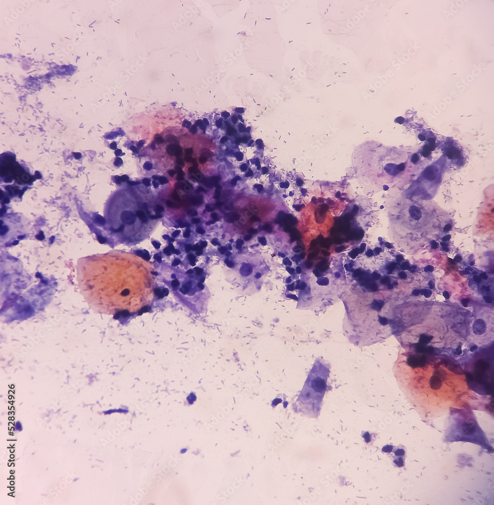 Abnormal squamous epithelial cells view in microscopy.HPV criteria for ...
