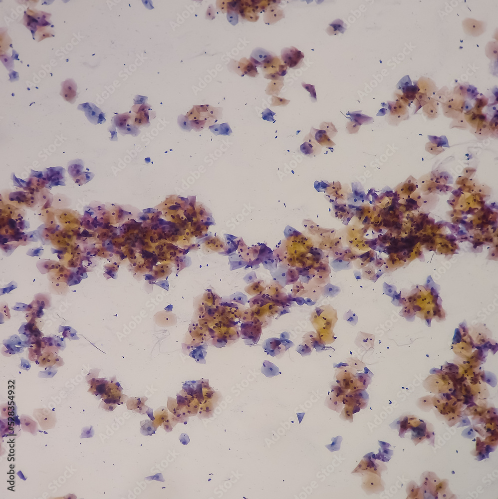 Abnormal squamous epithelial cells view in microscopy.HPV criteria for ...