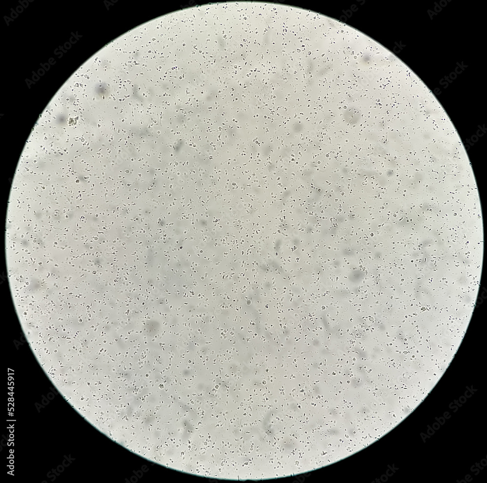 Semen analysis under microscopy showing Pyospermia or leukocytospermia ...