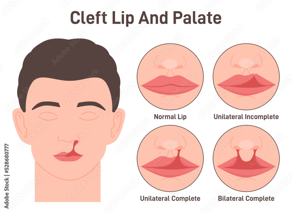 Cleft lip and cleft palate. Harelip. Human face with a birth defect ...