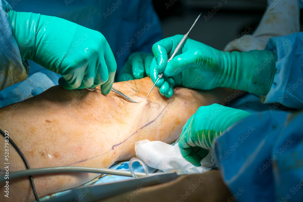 Process of varicose vein surgery in hospital, vein sealing, venous ...