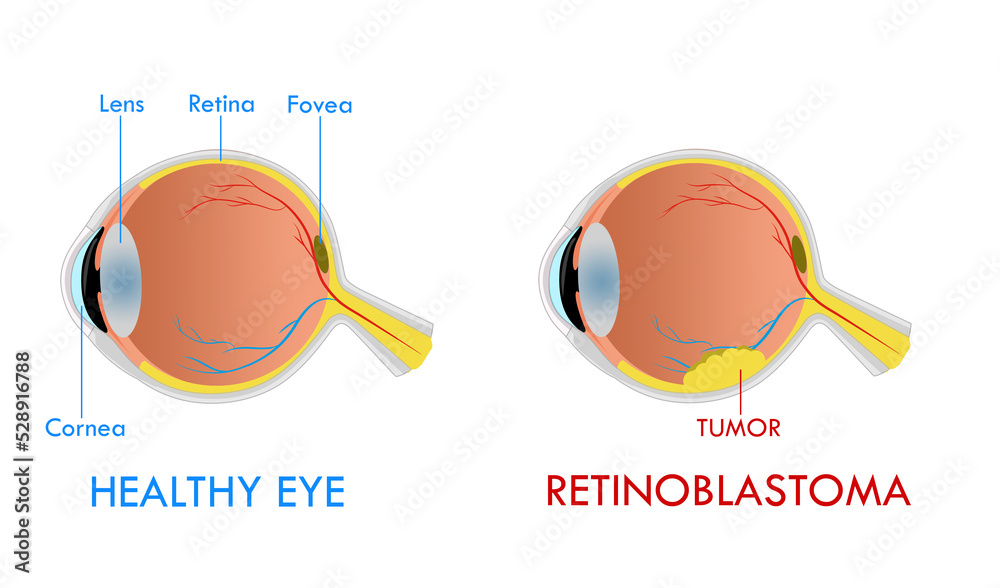 Retinoblastoma illustration diagram, anatomical scheme. Comparison ...