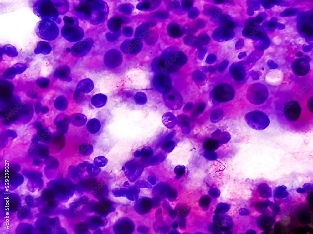 Foto de Stock Spindle Cell Sarcoma: an extremely rare bone cancer ...