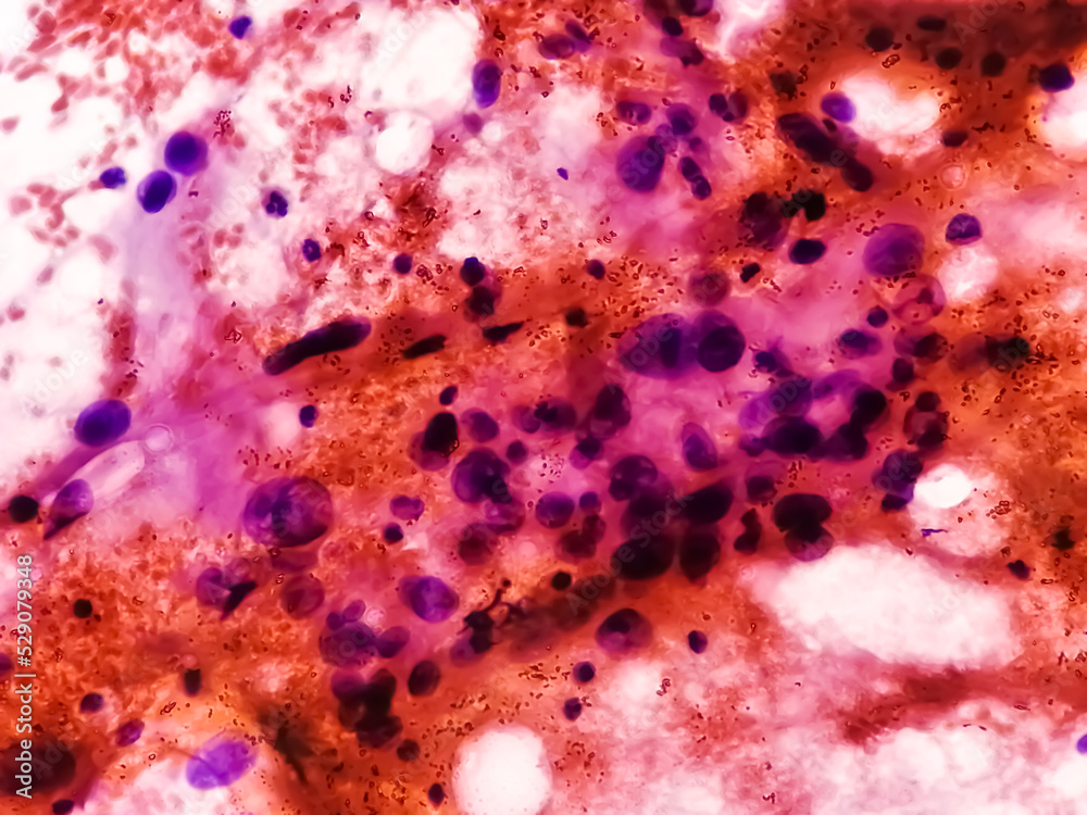 Spindle Cell Sarcoma: an extremely rare bone cancer. Photomicrograph of ...