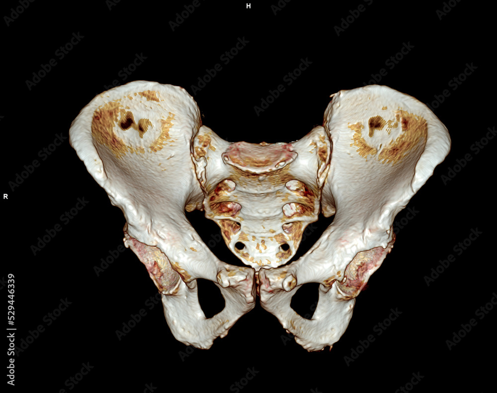 CT scan of Pelvic bone and hip joint 3D Stock Photo | Adobe Stock