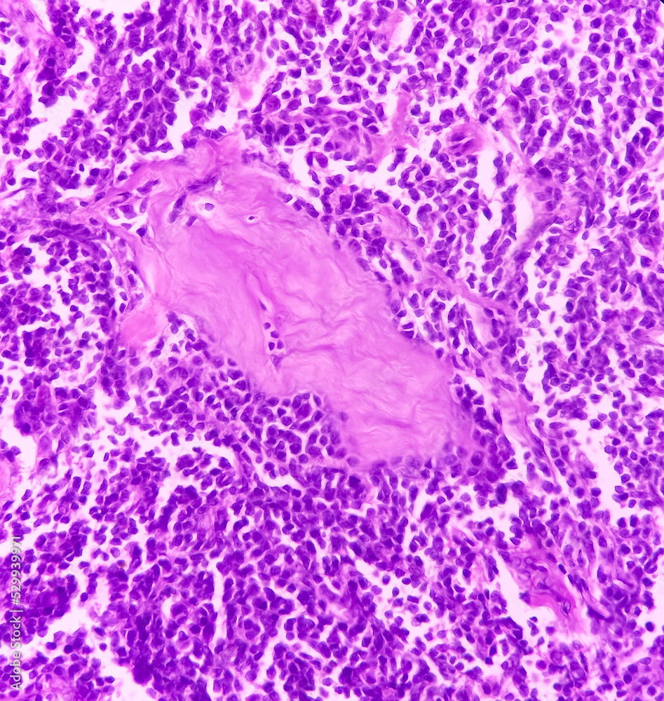 Supraclavicular lymph node biopsy: Microscopic image showing benign ...