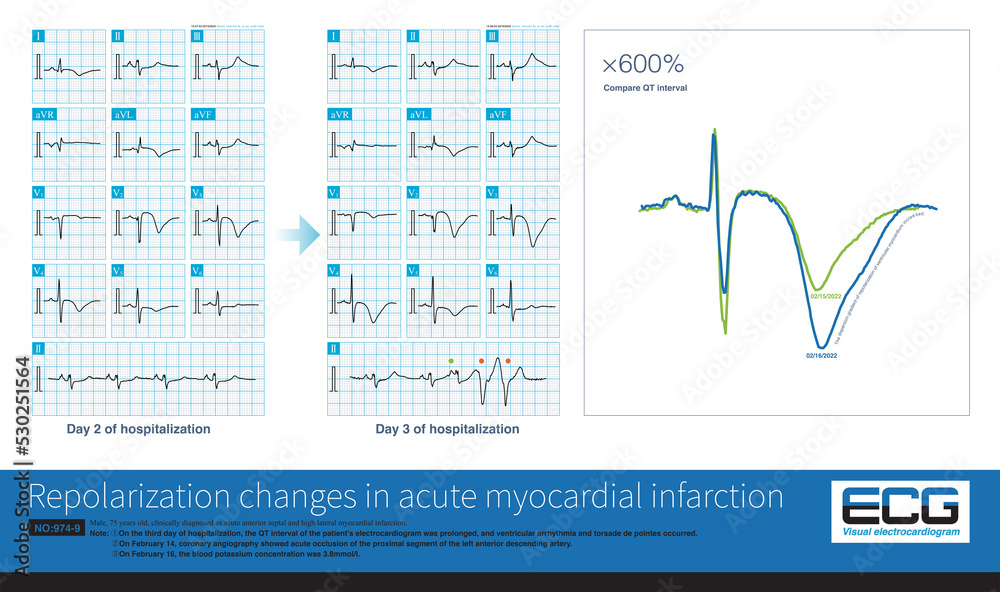 In acute myocardial infarction, the dynamic change of repolarization ...