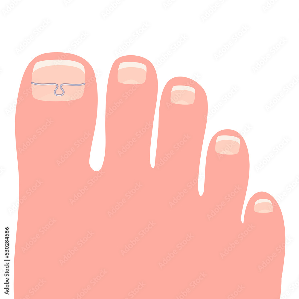 Toes on the right foot with a titanium staple on the thumb for ...