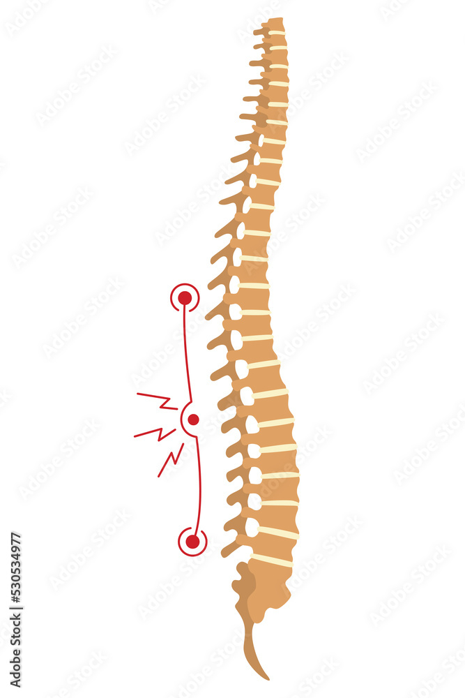 Spinal deformity. Symbol of spine curvatures or unhealthy backbones ...