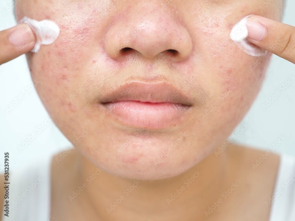 Woman face with acne inflammation (Papule and Pustule) on her face and ...