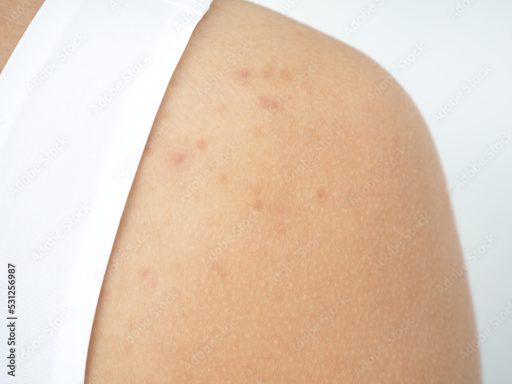 Teenage girl there are many red spots on the back from acne hormones ...