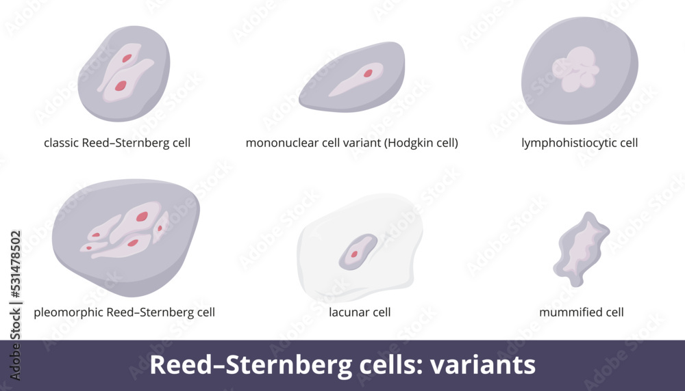 Reed–Sternberg cells. Six variants: classic, mononuclear cell variant ...