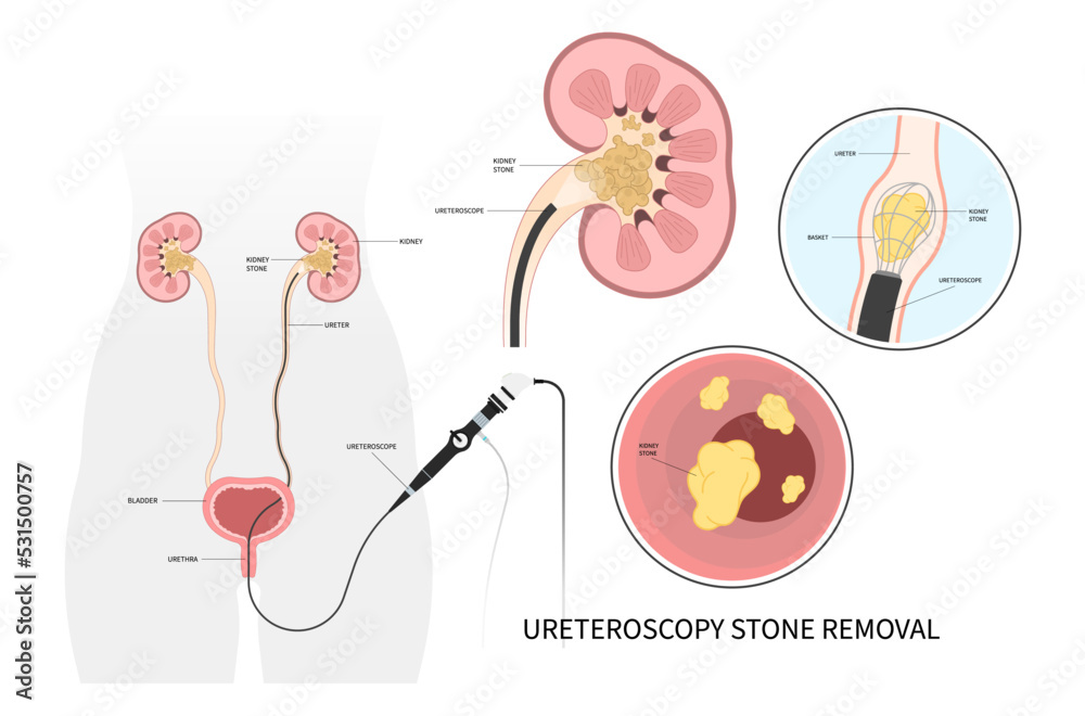 Vector de Stock urologist biopsy treatment Kidney stone removal uric ...